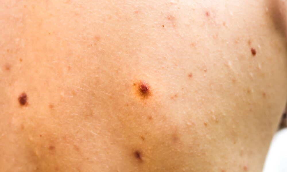 5 Types of Harmless Bumps on the Skin - Lifebru